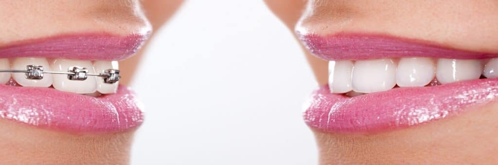 Orthodontics Courses Online as a Guide to “Straight Wire Braces”