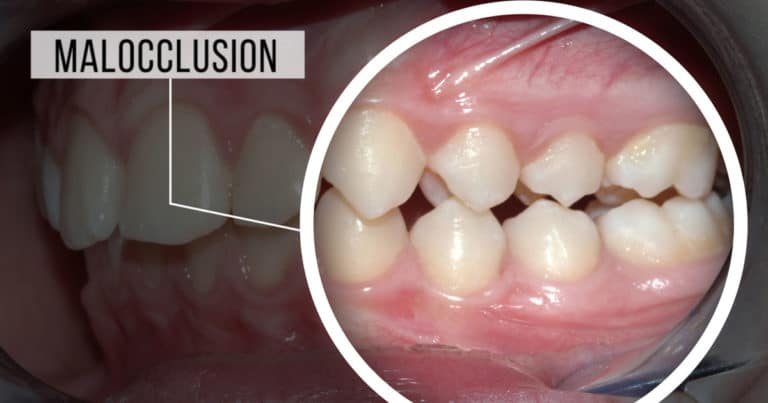 Malocclusion : Causes, Symptoms, Classification and Treatment - Sound ...