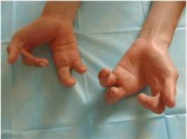 Congenital Deformity – Types, Causes, and Treatments - Sound Health Doctor