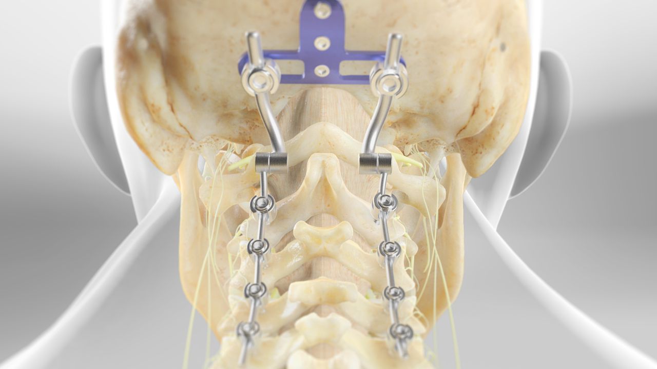 Cervical Fusion - Indications And Contraindications, Methods of Surgery ...